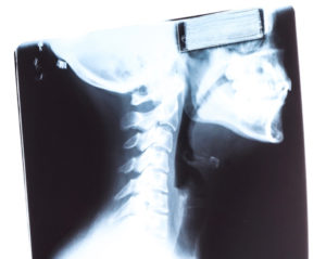 Migraine Surgery Santa Barbara | Headache Specialist Denver
